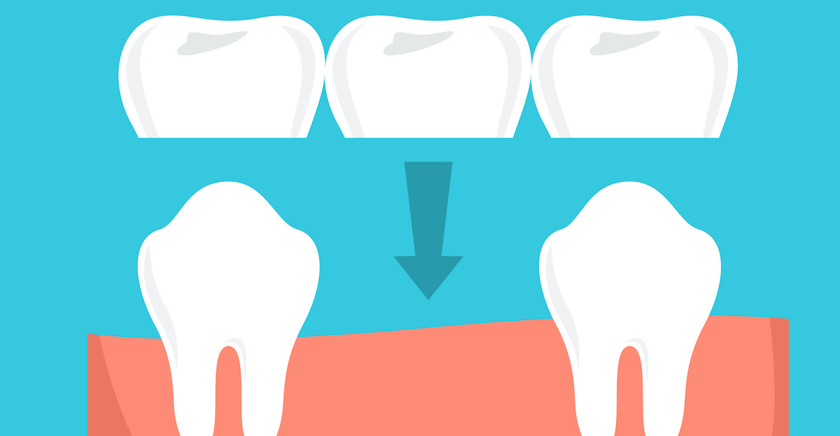 What are the different types of bridges for teeth? | Warrier Family ...