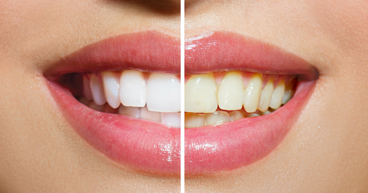 Is it worth getting your teeth whitened at the dentist?