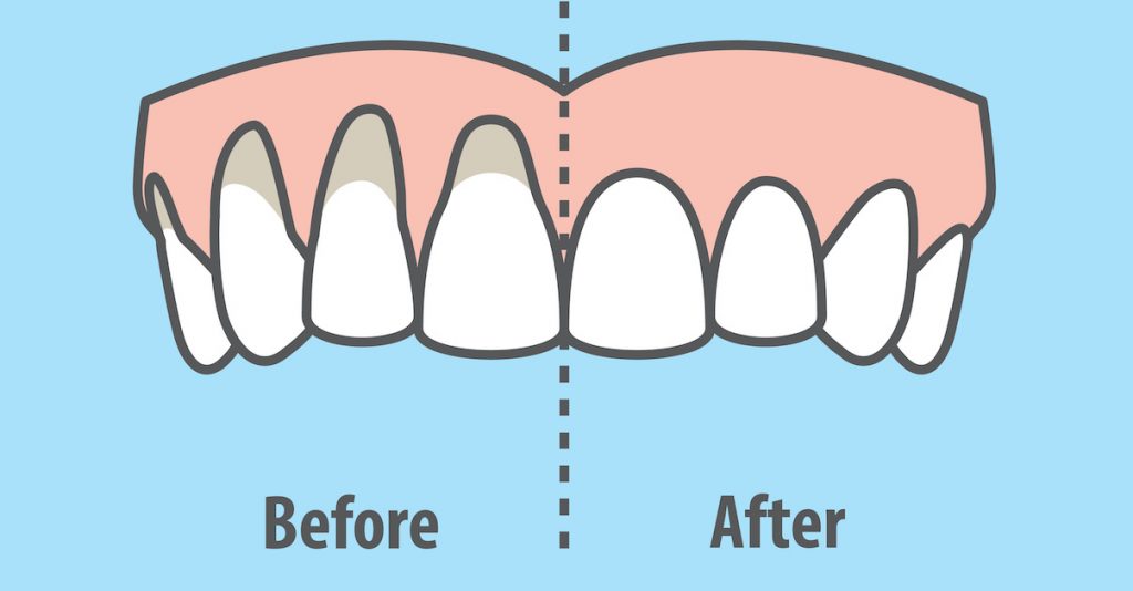 Is a Root Canal Tooth Dead After It's Treated? | Warrier Dentistry